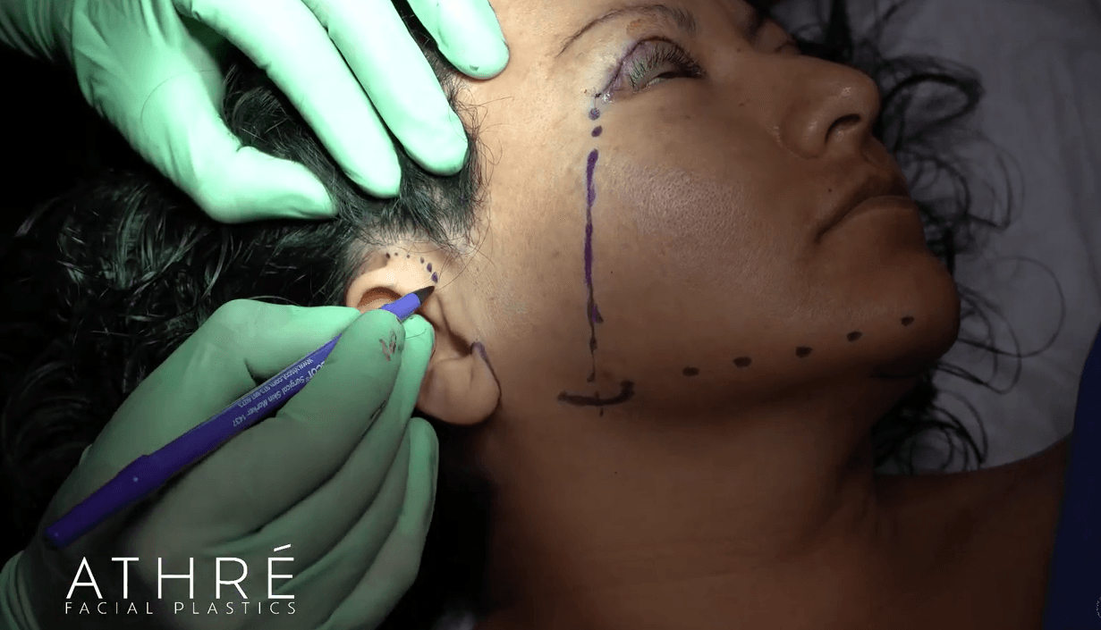 Surgery Videos | Athré Facial Plastics